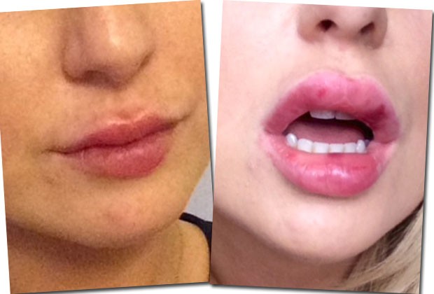 Como é Feito O Preenchimento Labial Beleza Cultura Mix